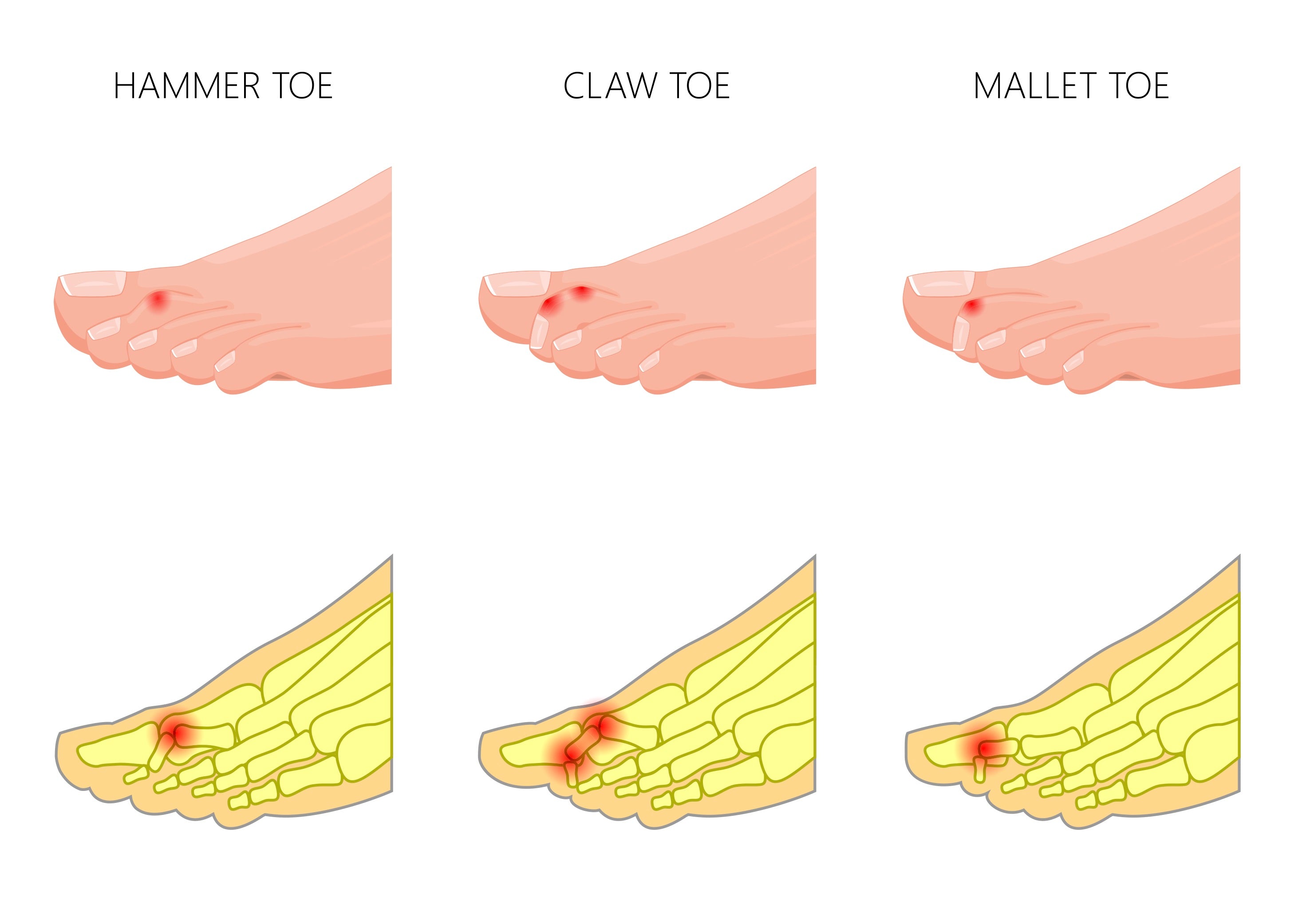 Claw Toe, Hammer Toe and Mallet Toe – Foot Scientific Store