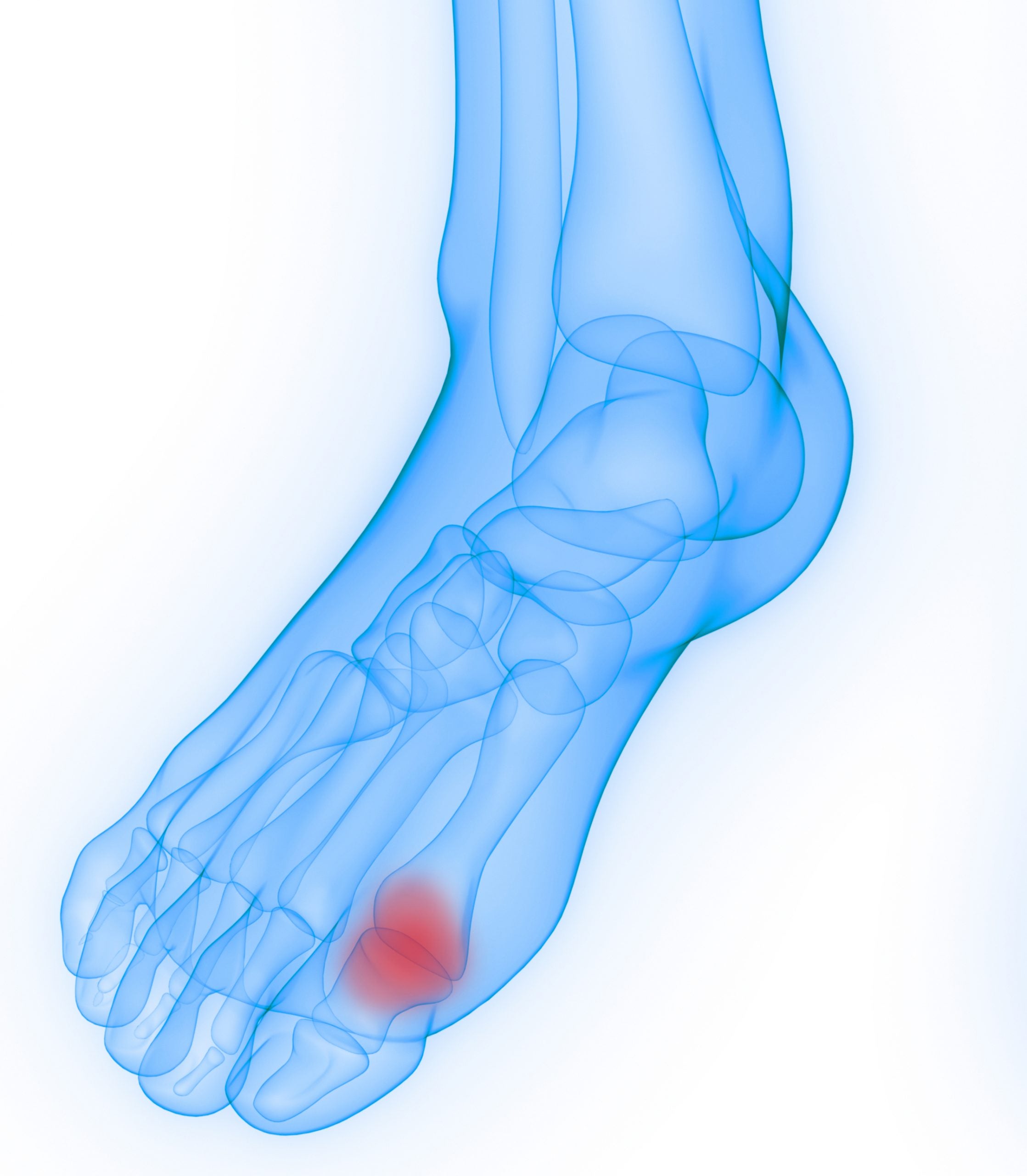 Hallux Limitus Rigidus – Foot Scientific Store
