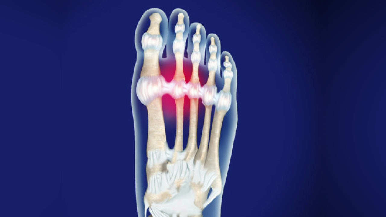 MTP Synovitis – Foot Scientific Store